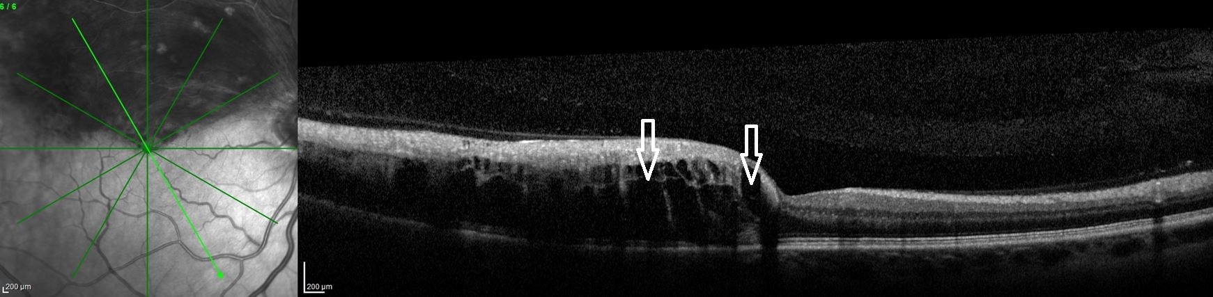 Branch Retinal Vein Occlusion in a Patient With Familial Hyperlipidemia ...