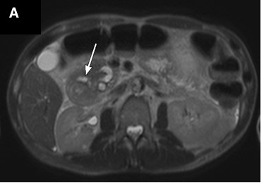 Groove Pancreatitis in a Patient With Recurrent Abdominal Pain and ...