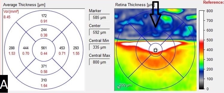 Branch Retinal Vein Occlusion in a Patient With Familial Hyperlipidemia ...