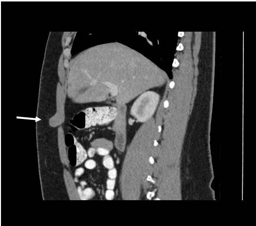 Clear Cell Sarcoma in the Upper Abdomen | Consultant360