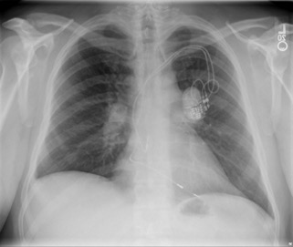 Lofgren Syndrome | Consultant360