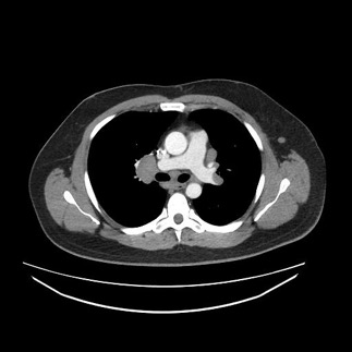 Lofgren Syndrome | Consultant360