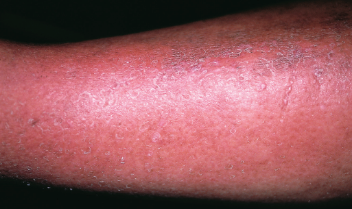 Why Is This Man’s Leg Painful, Swollen, and Red? | Consultant360