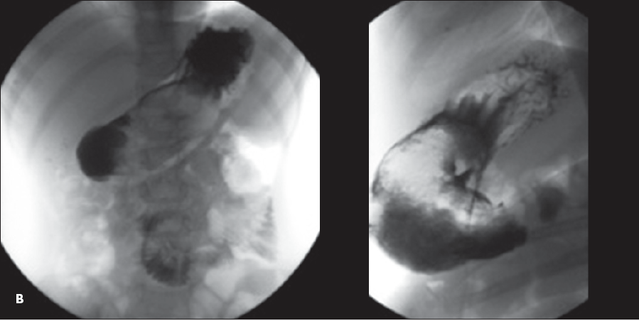Trichobezoars | Consultant360