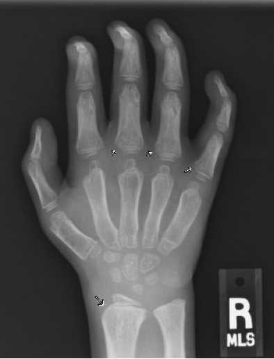 Why Does This Boy Have Multiple Joint Contractures? | Consultant360
