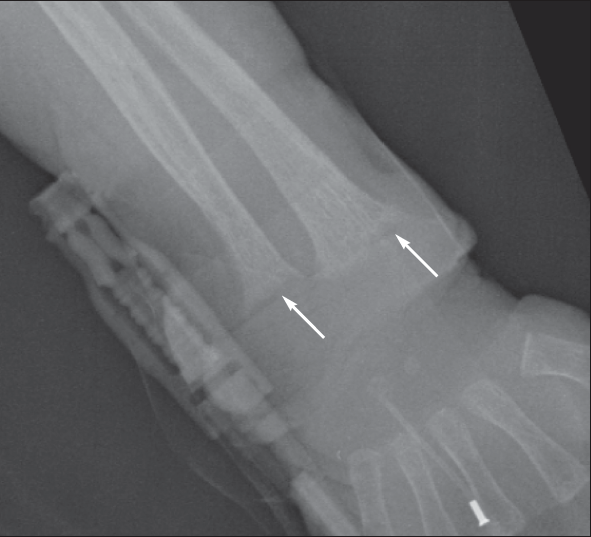 Vitamin D Deficiency Rickets | Consultant360