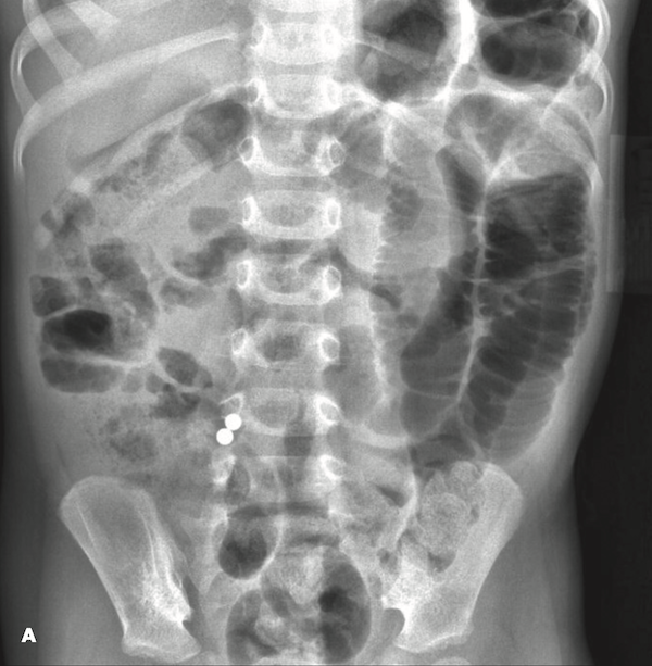 Complications of Multiple Magnet Ingestion | Consultant360
