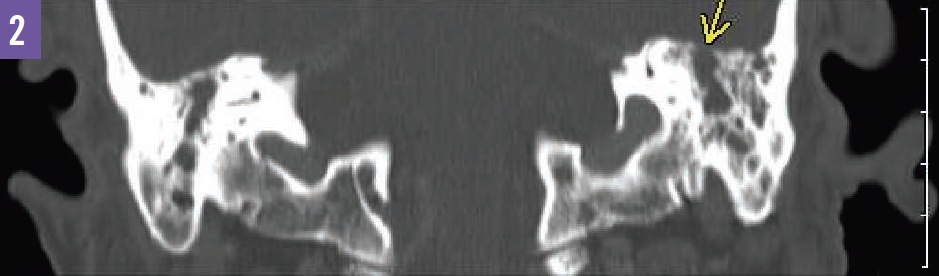 Mastoiditis as a Complication of Untreated Otitis Media | Consultant360