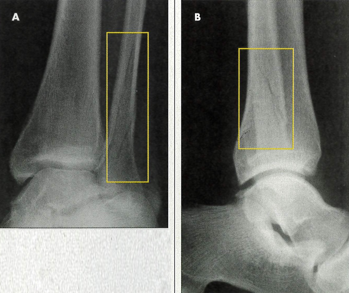 Office Management of Acute Ankle Injuries: Part 1 | Consultant360