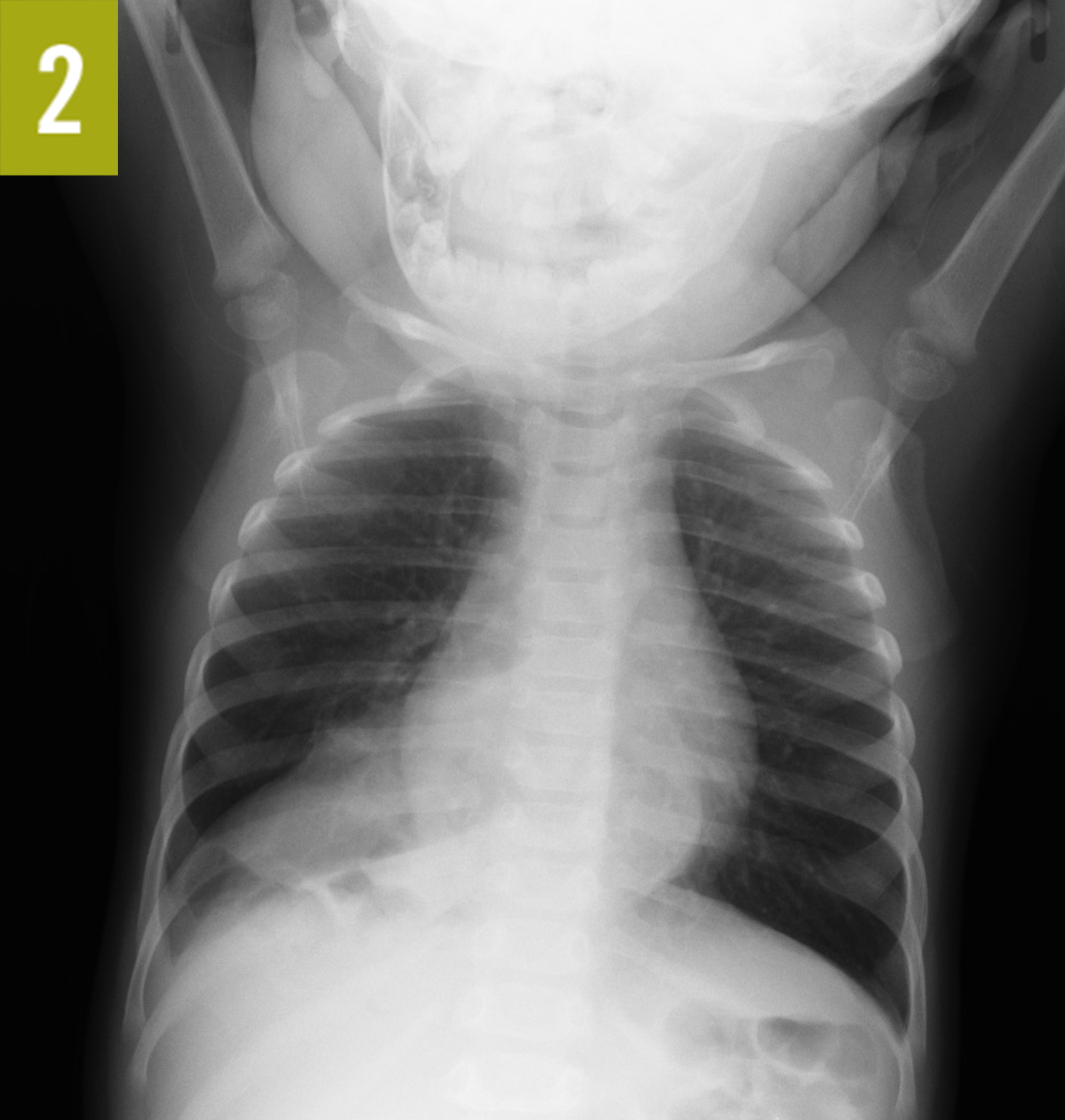 Postoperative Naloxone-Induced Pulmonary Edema | Consultant360