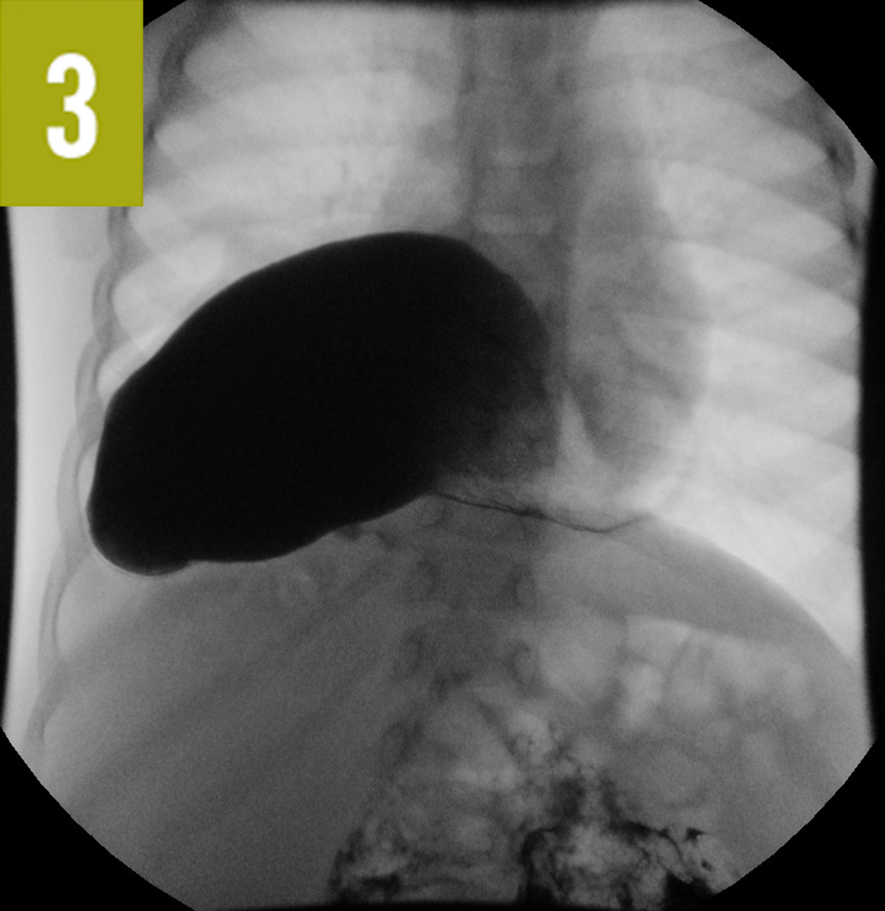 Methicillin-Susceptible Staphylococcus aureus Pacemaker Lead ...