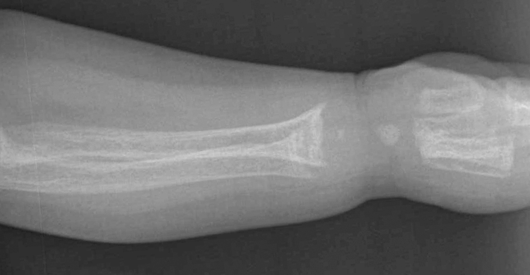 Case in Point: Hypophosphatemic Rickets | Consultant360