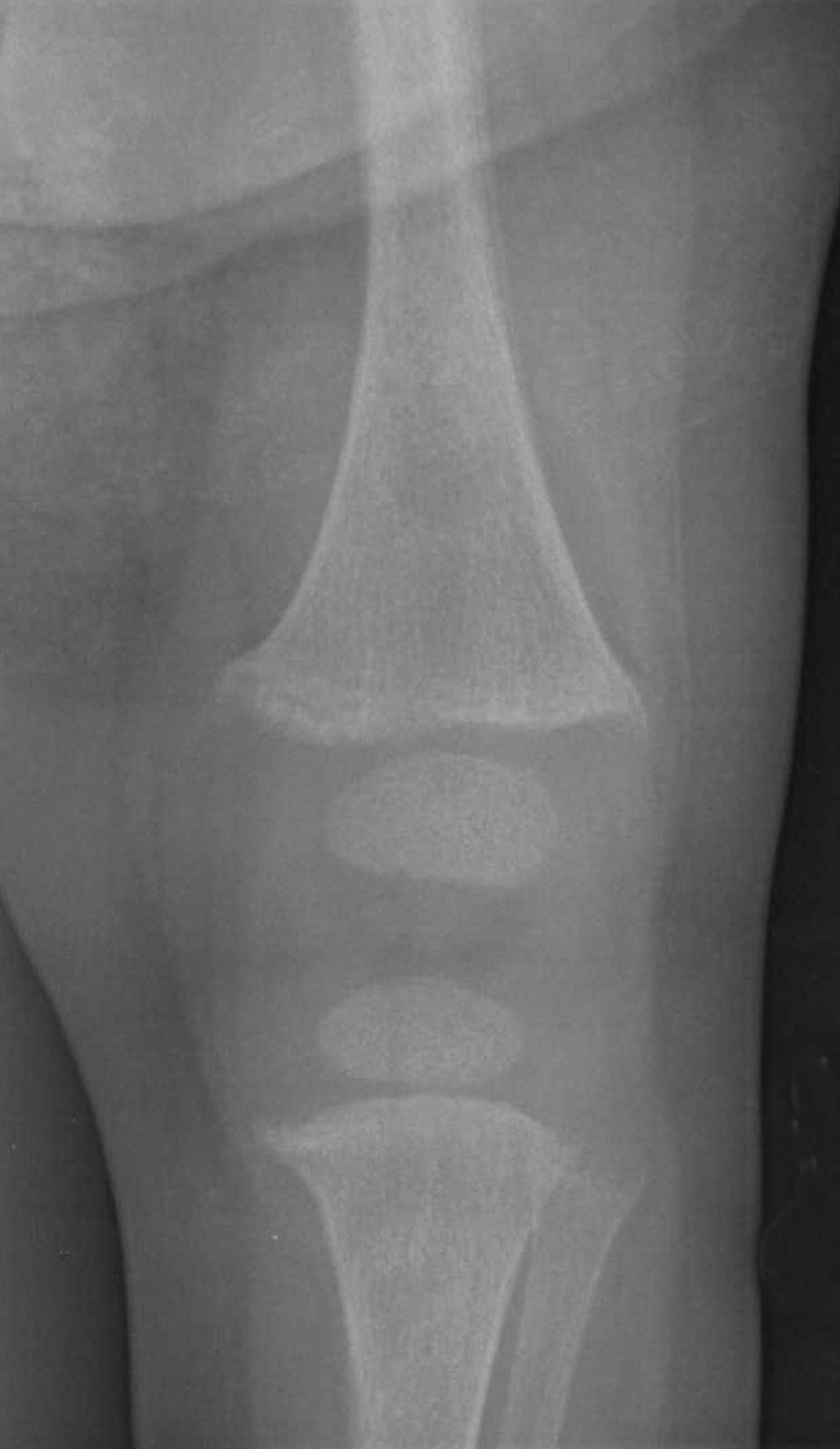 Case in Point: Hypophosphatemic Rickets | Consultant360