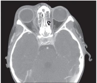 Orbital Abscess | Consultant360
