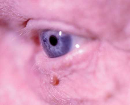 What explains this tender, pruritic patchy rash? | Consultant360