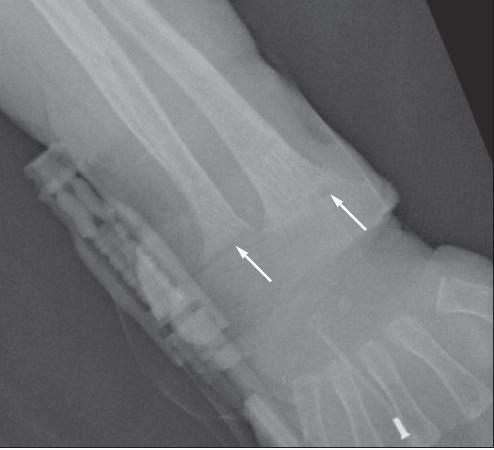 Vitamin D Deficiency Rickets | Consultant360