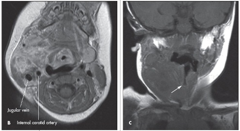 Cystic Hygroma in a Toddler | Consultant360