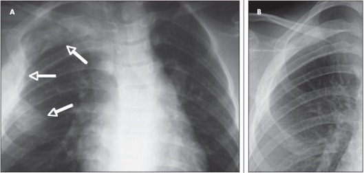 Chronic Recurrent Multifocal Osteomyelitis: An Illustrative Case ...