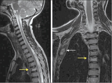 Chronic Recurrent Multifocal Osteomyelitis: An Illustrative Case ...