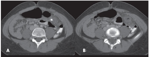 Left-Sided Appendicitis With Intestinal Malrotation | Consultant360
