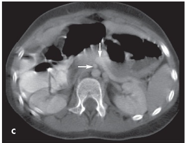 Left-Sided Appendicitis With Intestinal Malrotation | Consultant360