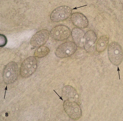 Fish Tapeworm Infestation | Consultant360