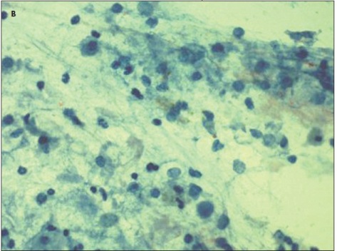 Heiner Syndrome | Consultant360