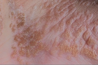 Ilven Can You Identify The Intensely Itchy Plaques On This Girl's Leg