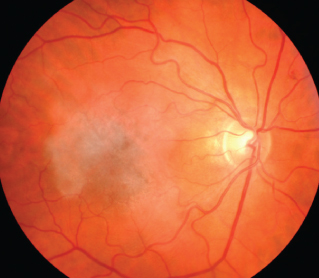 Fundus Medley: 5 Cases | Consultant360