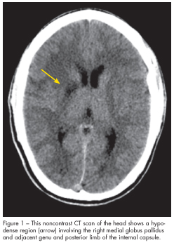 Young Man With Left-Sided Paralysis and Numbness | Consultant360