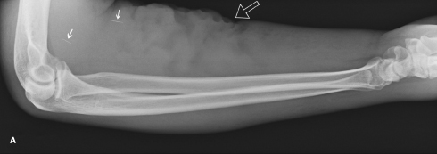 Intravenous Drug User With Hand and Forearm Pain | Consultant360