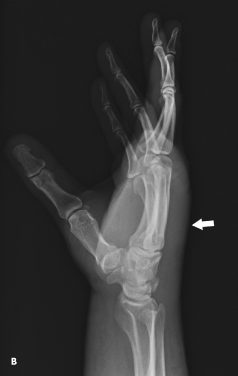 Intravenous Drug User With Hand and Forearm Pain | Consultant360