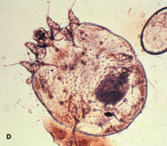 Scabies in Infant and Mother | Consultant360