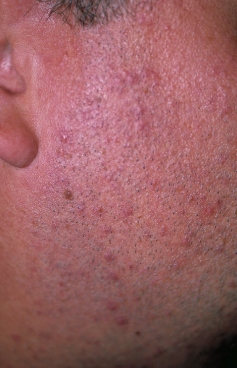 Can you identify this acneiform eruption? | Consultant360