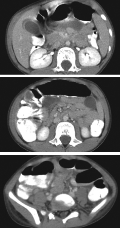 Typhoid Fever | Consultant360
