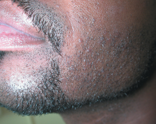 Wart or Mimic? | Consultant360