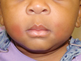 Popsicle Panniculitis | Consultant360