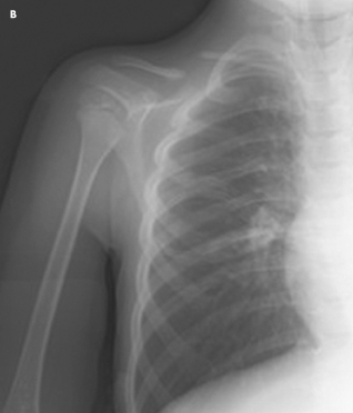 Congenital Pseudarthrosis of the Clavicle | Consultant360