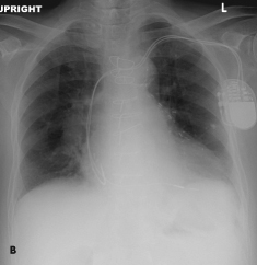 Was the Cure Worse Than the Disease? Case 4: Right Bundle-Branch Block ...