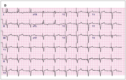 Was the Cure Worse Than the Disease? Case 4: Right Bundle-Branch Block ...