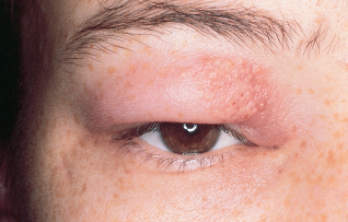 Can You Identify These Periorbital Lesions? | Consultant360