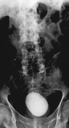 Urinary Bladder Megalithiasis | Consultant360