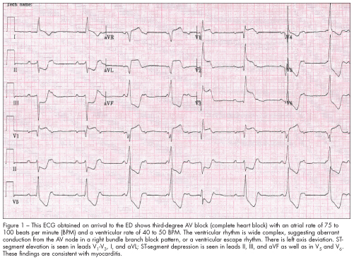 Myocarditis With Complete Heart Block: Challenges in Diagnosis and ...
