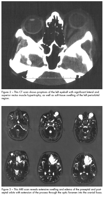 Young Woman With Left Eye Swelling and Pain | Consultant360