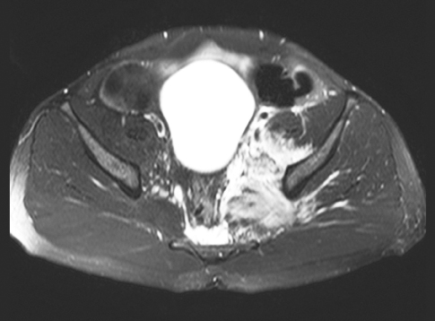 Non-immunocompromised Pyomyositis | Consultant360