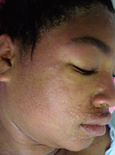 12-year-old girl with bullous rash | Consultant360