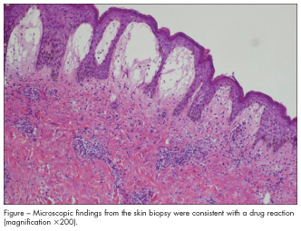 12-year-old girl with bullous rash | Consultant360