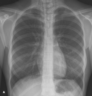 Continuous Diaphragm Sign