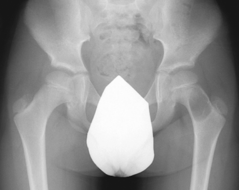 What is causing this 9-year-old to limp? | Consultant360