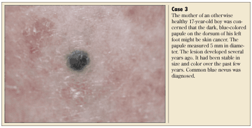 Lumps and Bumps in Adolescents: Benign Tumors, Growths, and Mucosal ...